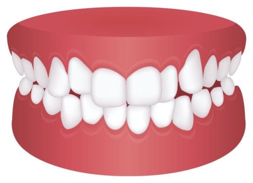 The Different Types of Bite Problems | Flower Mound Orthodontist