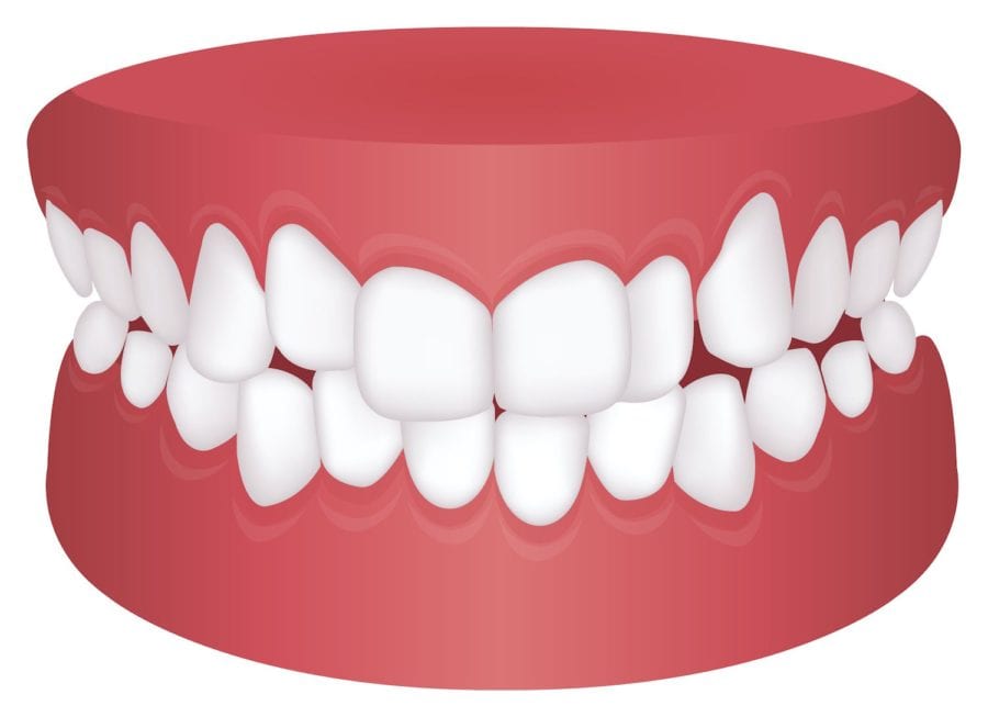 The Different Types of Bite Problems | Flower Mound Orthodontist