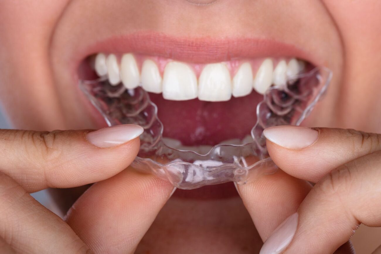 Learn About the Invisalign Timeline - Flower Mound, TX Dentistry